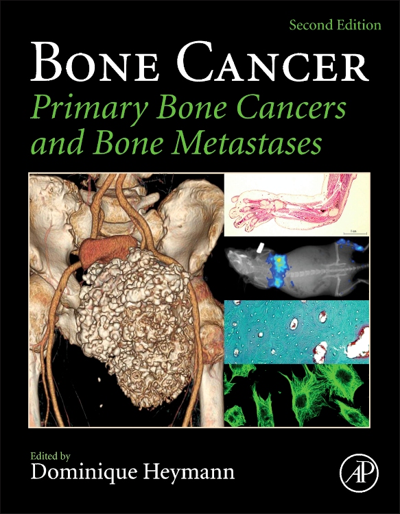 Bone Cancer - Edition 2 - Edited by Dominique Heymann Elsevier ...
